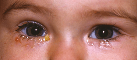 Watery Eyes in Children due to Duct Blockage - Eye Surgeon